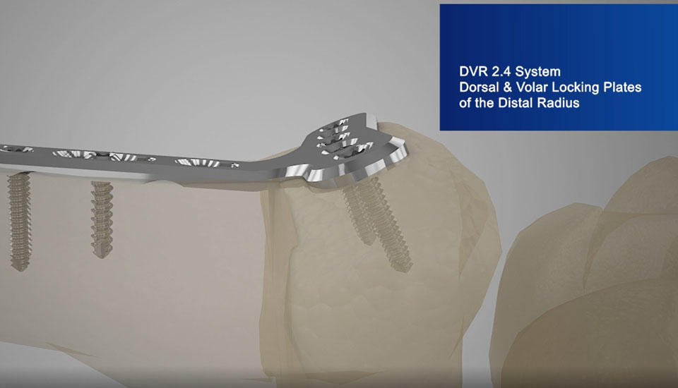 Volar Distal Radius Plate System