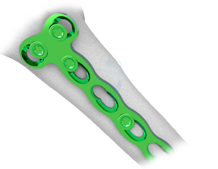 Compact Hand System - Hand Plates (LCP)